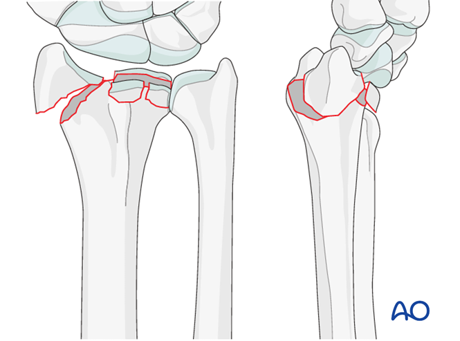 ORIF - Dorsoradial double plate for Partial articular, fragmentary ...