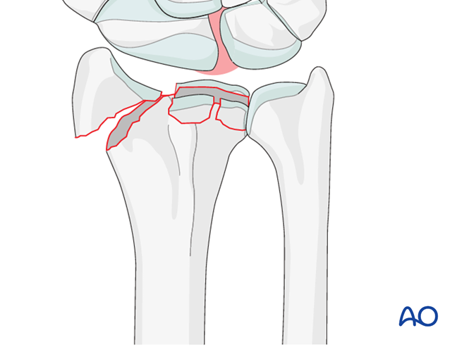 ORIF - Dorsoradial double plate for Partial articular, fragmentary ...