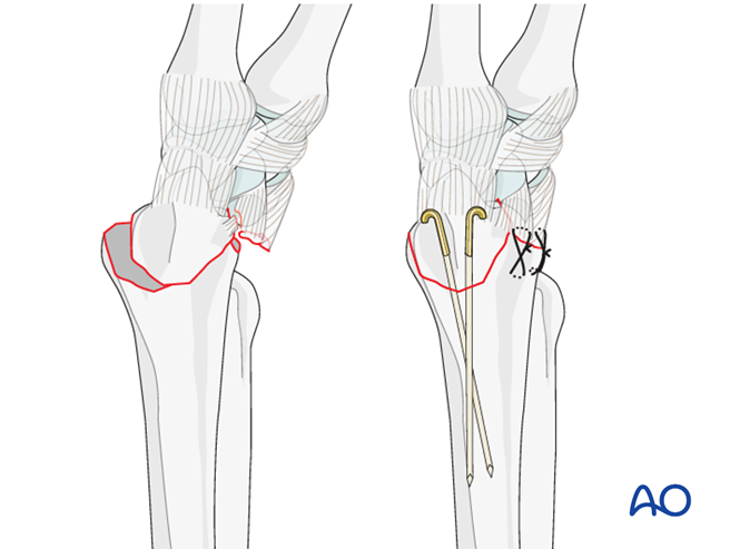 ORIF - Dorsoradial double plate for Partial articular, fragmentary ...