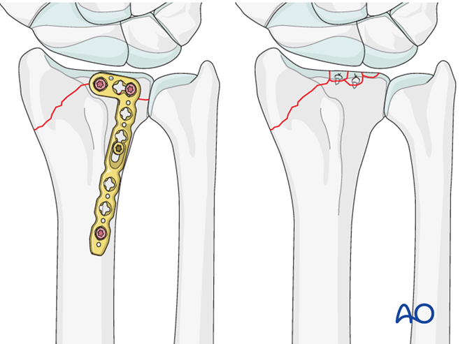 ORIF - Dorsoradial double plate for Partial articular, fragmentary ...
