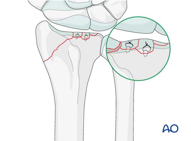 ORIF - Dorsoradial double plate for Partial articular, fragmentary ...
