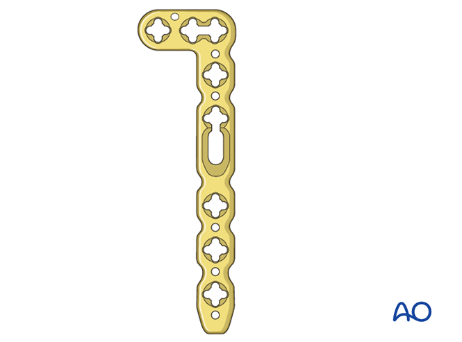 ORIF - Dorsoradial double plate for Partial articular fracture of the ...