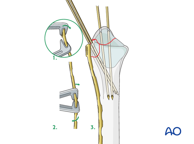 ORIF - Dorsoradial double plate for Partial articular fracture of the ...