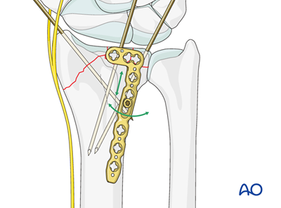 ORIF - Dorsoradial double plate for Partial articular, fragmentary ...