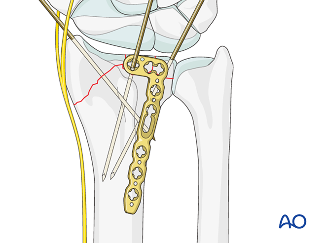 ORIF - Dorsoradial double plate for Partial articular, fragmentary ...
