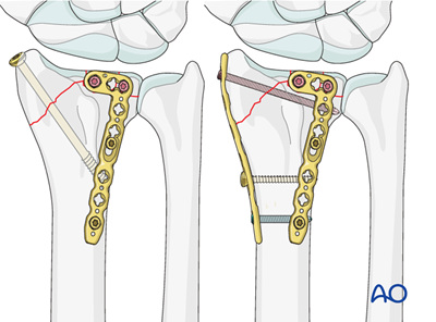 ORIF - Dorsoradial double plate for Partial articular, fragmentary ...