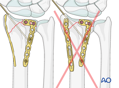 ORIF - Dorsoradial double plate for Partial articular, fragmentary ...