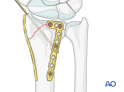ORIF - Dorsoradial double plate for Partial articular, fragmentary ...
