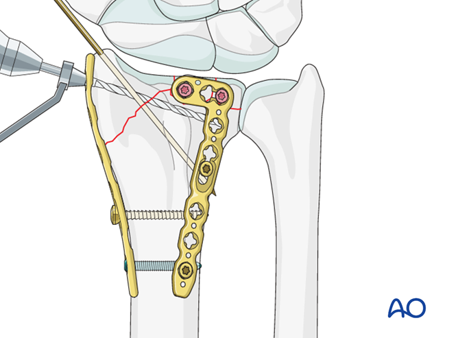 ORIF - Dorsoradial double plate for Partial articular, fragmentary ...