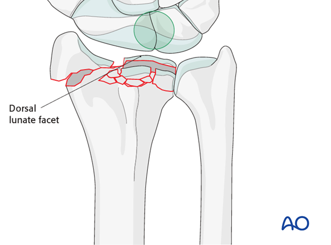 ORIF - Dorsoradial double plate for Partial articular fracture of the ...