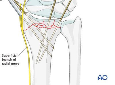 ORIF - Dorsoradial double plate for Partial articular fracture of the ...