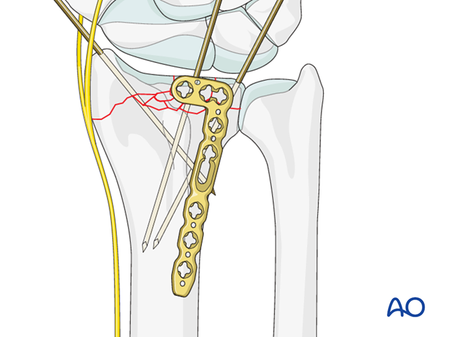 ORIF - Dorsoradial double plate for Partial articular fracture of the ...