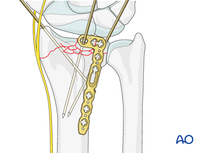 ORIF - Dorsoradial double plate for Partial articular fracture of the ...
