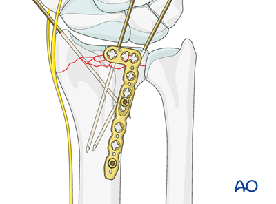 ORIF - Dorsoradial double plate for Partial articular fracture of the ...
