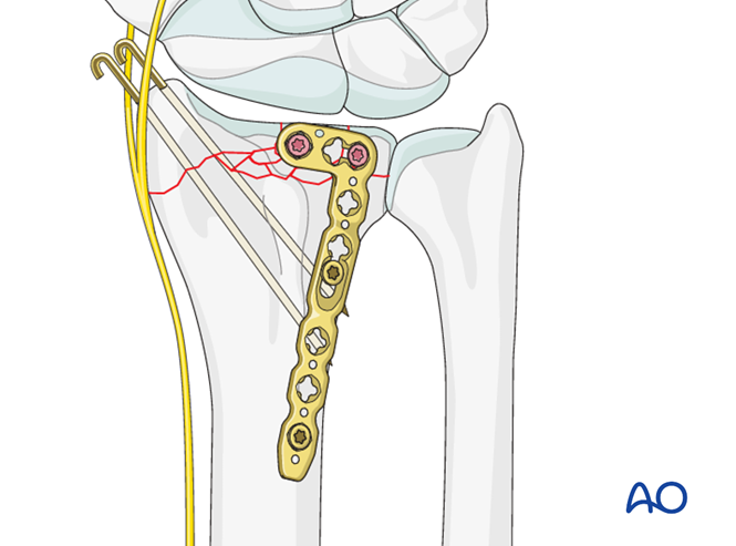 ORIF - Dorsoradial double plate for Partial articular fracture of the ...