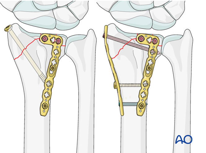 ORIF - Dorsoradial double plate for Partial articular fracture of the ...