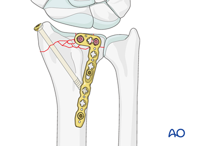 ORIF - Dorsoradial double plate for Partial articular fracture of the ...