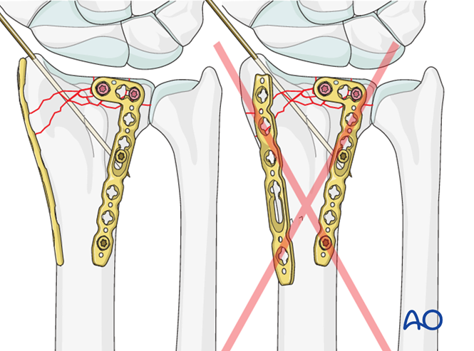 ORIF - Dorsoradial double plate for Partial articular fracture of the ...