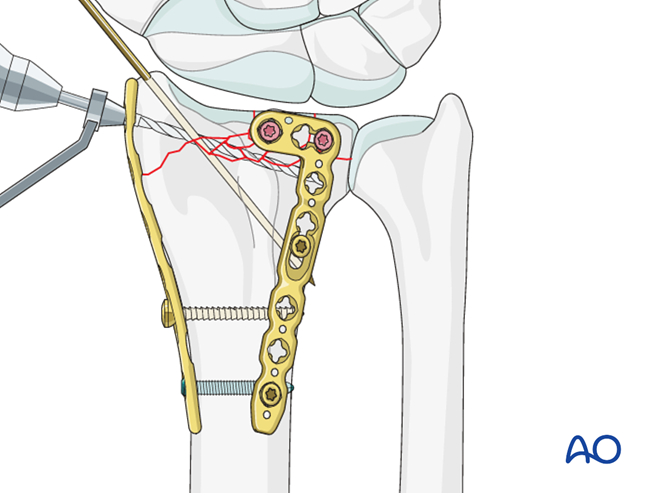 ORIF - Dorsoradial double plate for Partial articular fracture of the ...