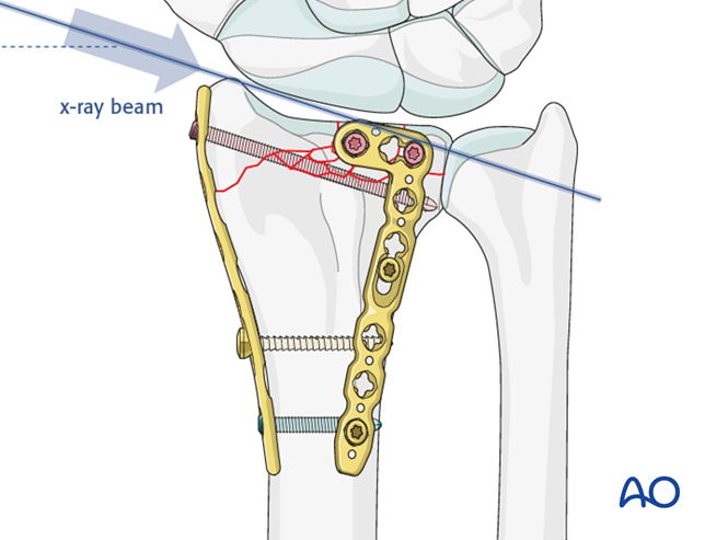 ORIF - Dorsoradial double plate for Partial articular fracture of the ...