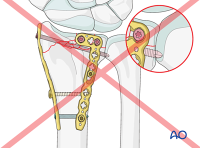 ORIF - Dorsoradial double plate for Partial articular fracture of the ...