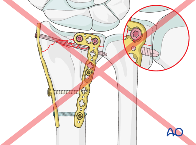 ORIF - Dorsoradial double plate for Partial articular fracture of the ...