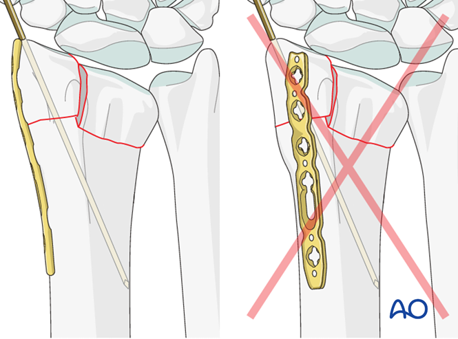 ORIF - Dorsoradial double plate for Complete simple articular, simple ...