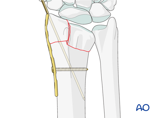 ORIF - Dorsoradial double plate for Complete simple articular, simple ...
