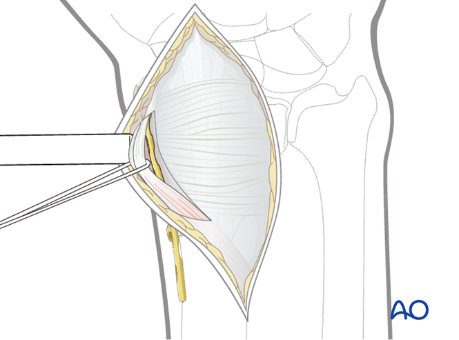 ORIF - Dorsoradial double plate for Complete simple articular, simple ...