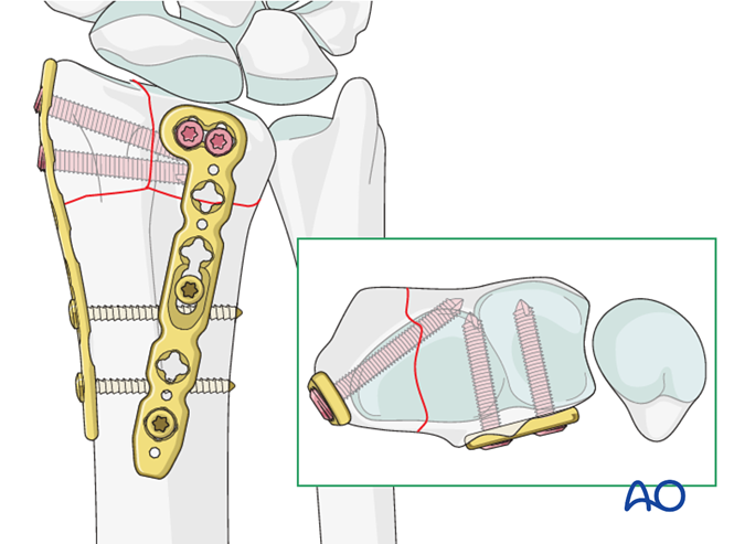 ORIF - Dorsoradial double plate for Complete simple articular, simple ...