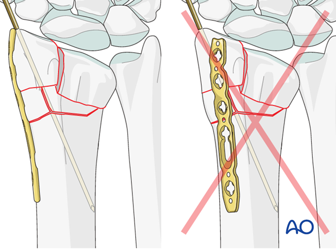 ORIF - Dorsoradial double plate for Complete simple articular ...