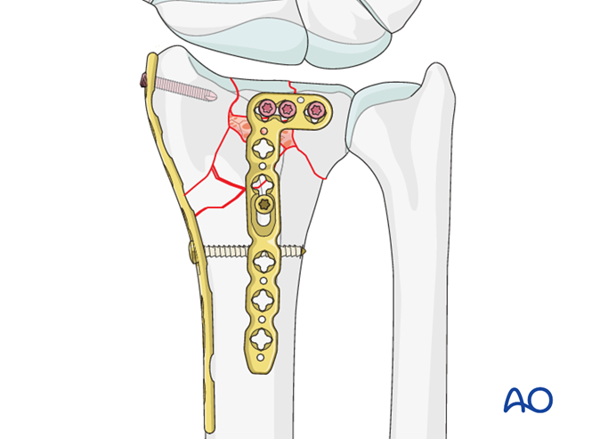 ORIF - Dorsoradial double plate for Complete multifragmentary fracture ...