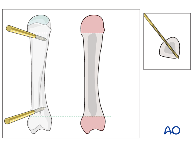 Joint-spanning external fixation (temporary or definitive) for ...