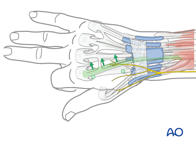 Joint-spanning external fixation (temporary or definitive) for Complete ...