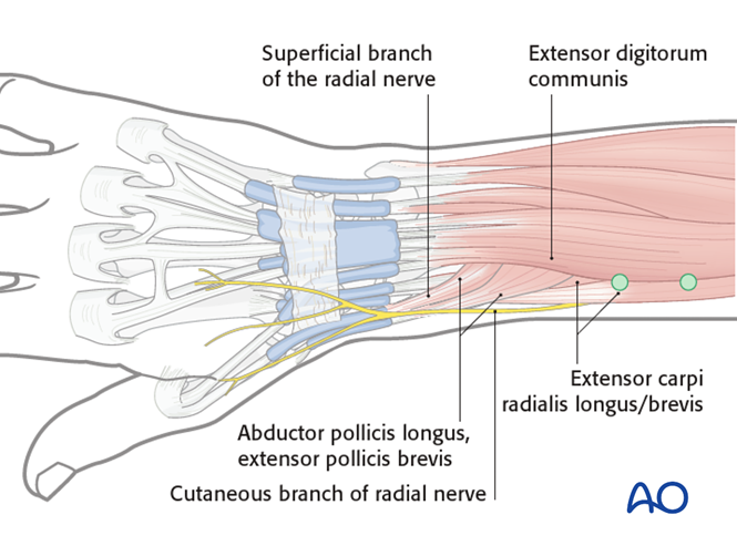 Joint-spanning external fixation (temporary or definitive) for ...