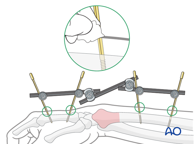 Closed reduction - K-wires and cast/external fixator for Extraarticular ...