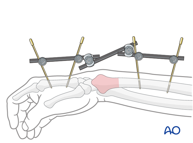 Joint-spanning external fixation (temporary or definitive) for Extraarticular undisplaced ...