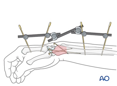 Closed reduction - K-wires and cast/external fixator for Extraarticular ...