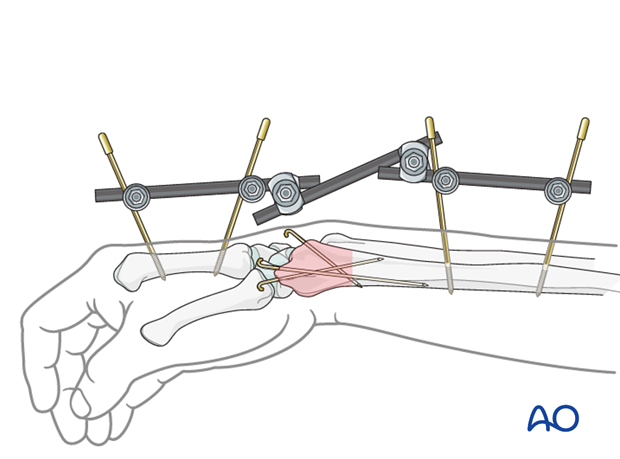 Closed Reduction K Wires And Cast External Fixator For Extraarticular
