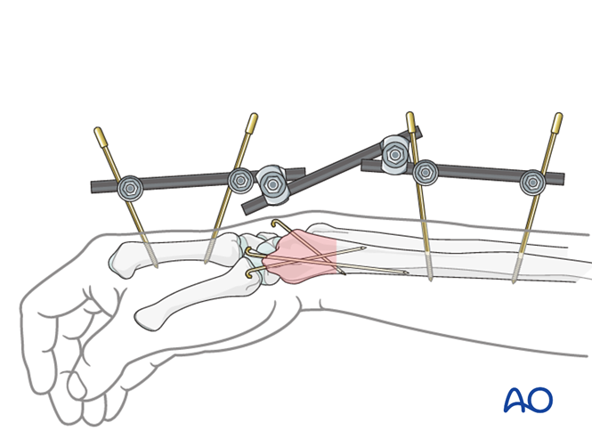 ORIF - Dorsoradial double plate for Partial articular fracture of the ...