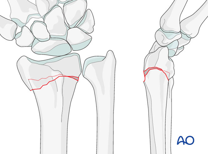 Closed reduction - K-wires and cast/external fixator for Extraarticular ...