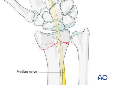 Closed reduction - K-wires and cast/external fixator for Extraarticular ...