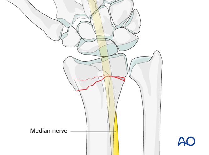 Closed reduction - K-wires and cast/external fixator for Extraarticular ...