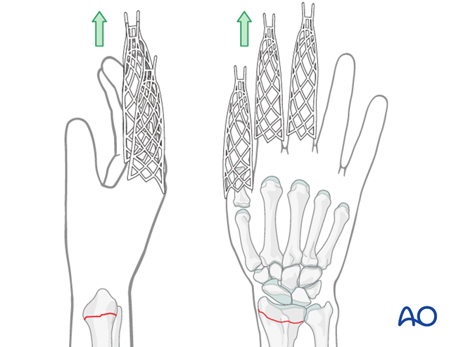 Closed Reduction K Wires And Cast External Fixator For Extraarticular
