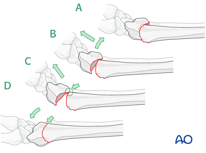 Closed reduction - K-wires and cast/external fixator for Extraarticular ...