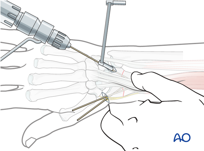Closed reduction - K-wires and cast/external fixator for Extraarticular ...