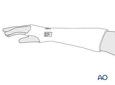 Closed reduction - K-wires and cast/external fixator for Extraarticular ...