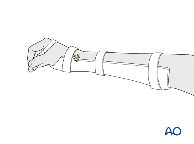 Closed reduction - K-wires and cast/external fixator for Extraarticular ...
