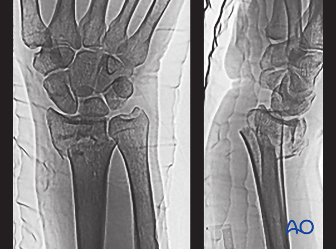 Closed reduction - K-wires and cast/external fixator for Extraarticular ...