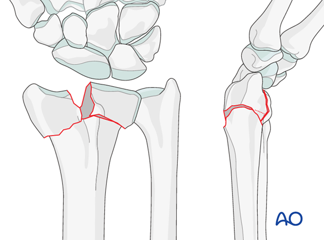 Closed reduction - K-wires and cast/external fixator for Complete ...